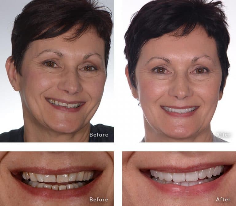 Before After Transformation – Prosmiles